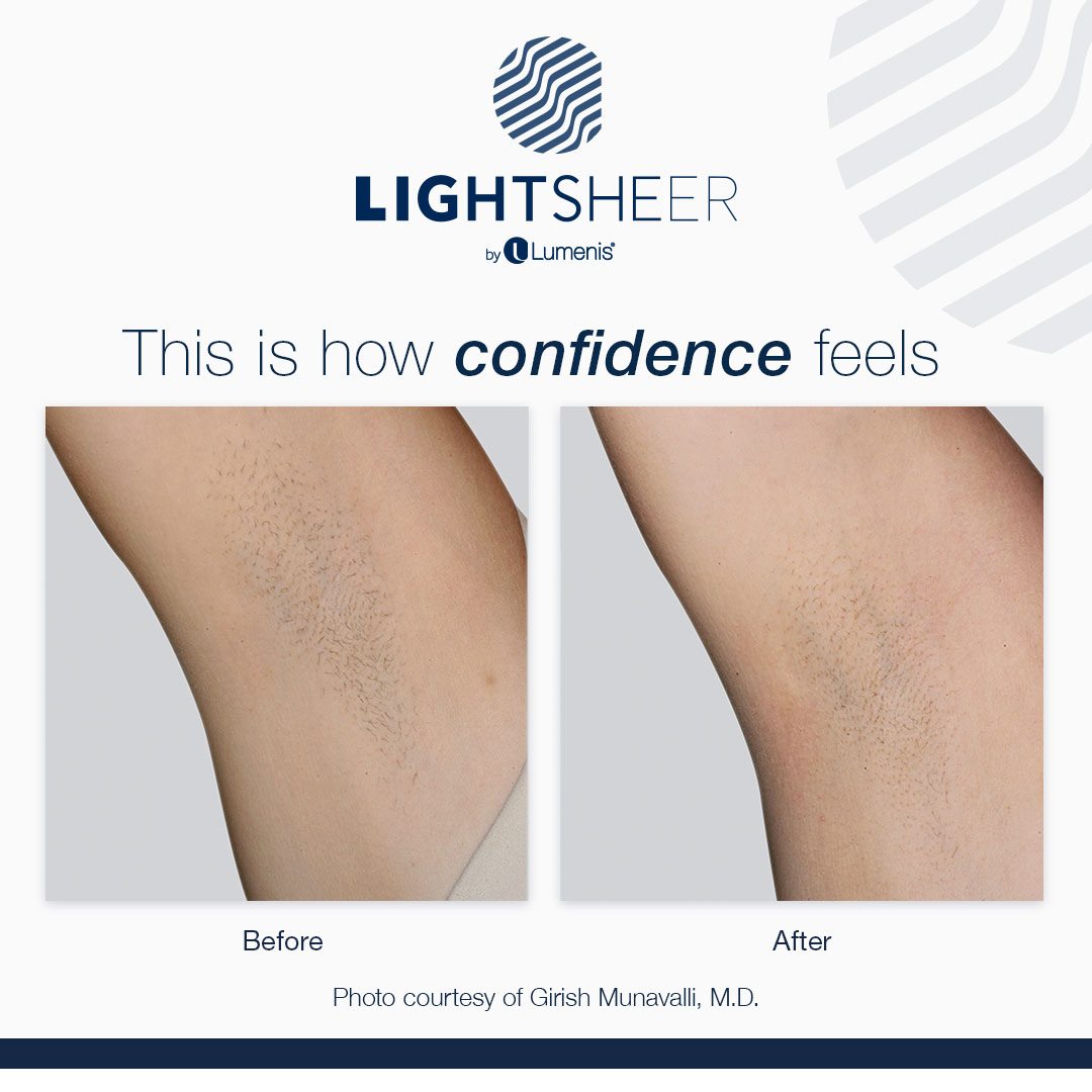 Laser Hair Removal Methods | Cambridge Clear Beauty